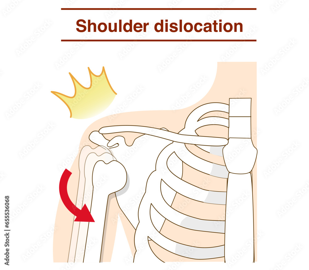 Poster Mechanism of shoulder joint dislocation – Wall Art | UkPosters