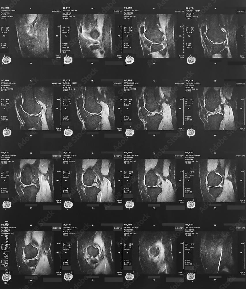 Poster Knee cap patella magnetic resonce. Osteoarthritis. Anatomy ...