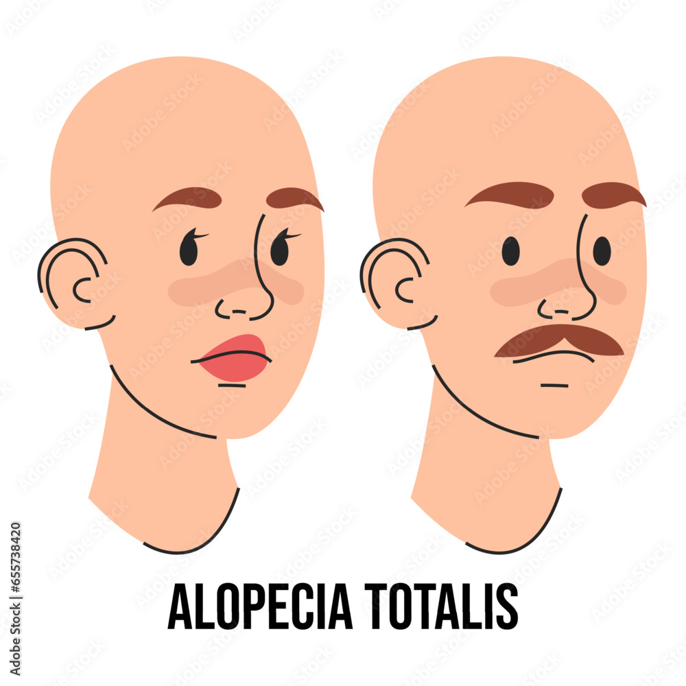Alopecia totalis vector isolated. Male and female character suffering ...