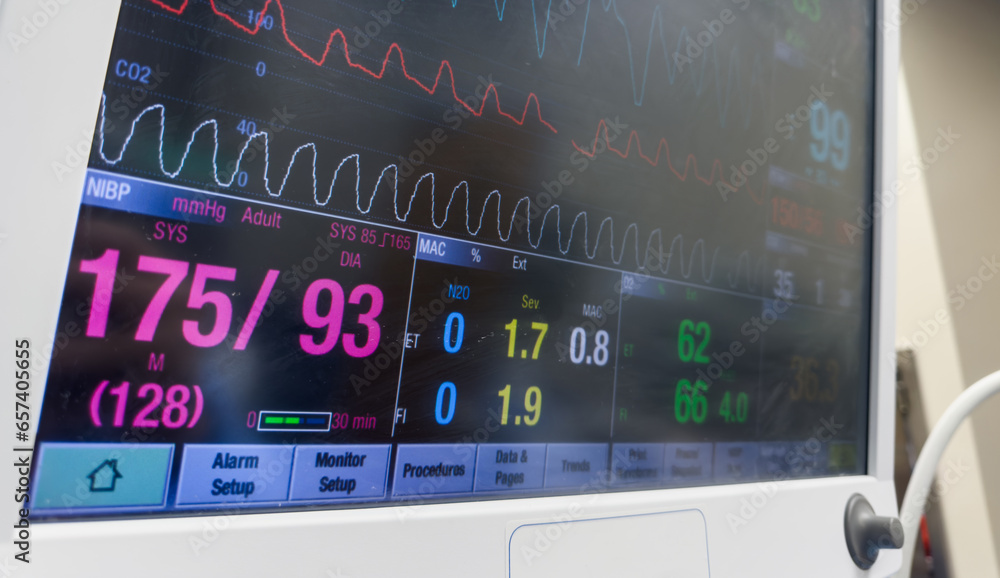 Medical monitor displays vital signs with graphs and numbers, heart ...