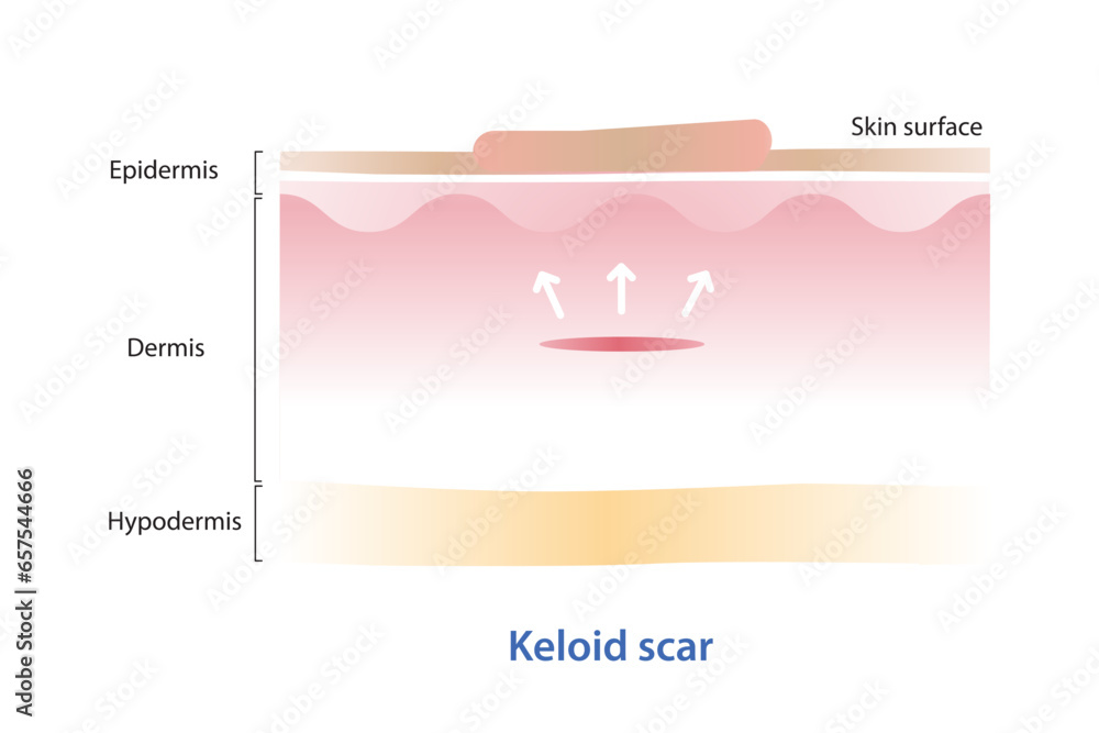 Keloid scar on skin surface vector illustration isolated on white ...