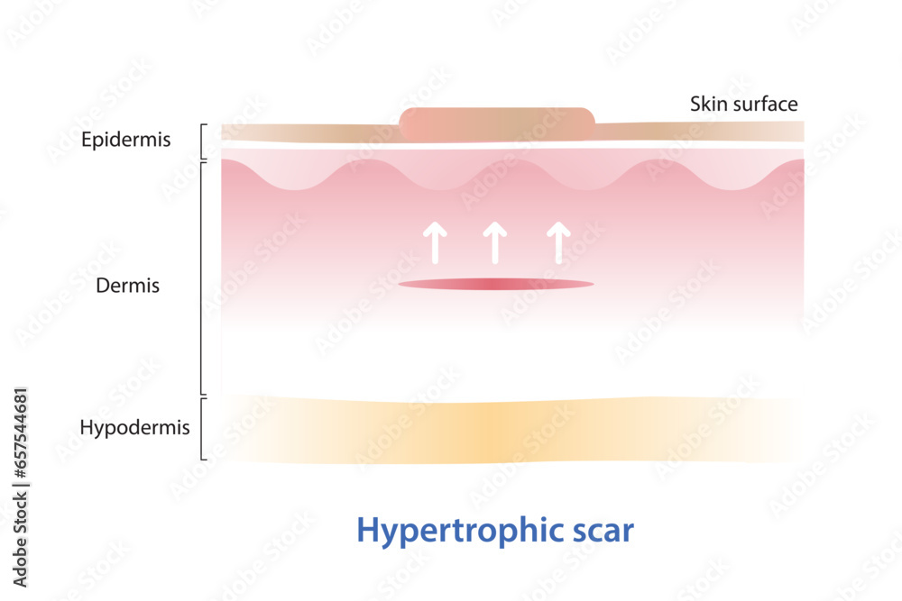 Hypertrophic scar on skin surface vector illustration isolated on white ...