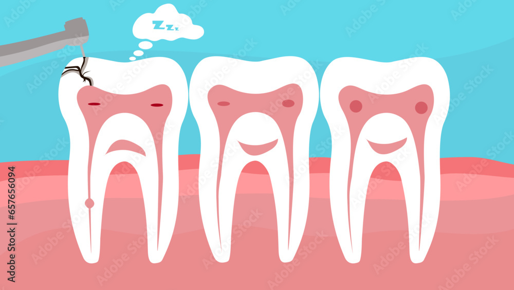 drilling tooth, drilling a tooth, scene of a sleeping tooth and ...