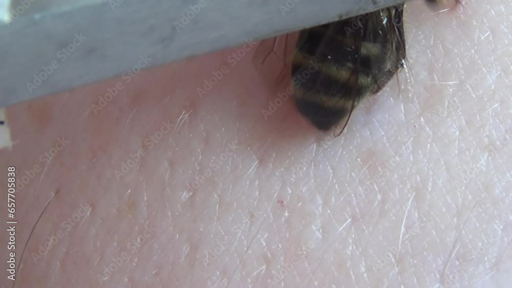 Apitherapy. With the help of tweezers, the bee is placed on the skin of ...
