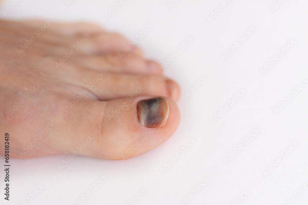 Subungual hematoma present under the toenail of the hallux, more ...