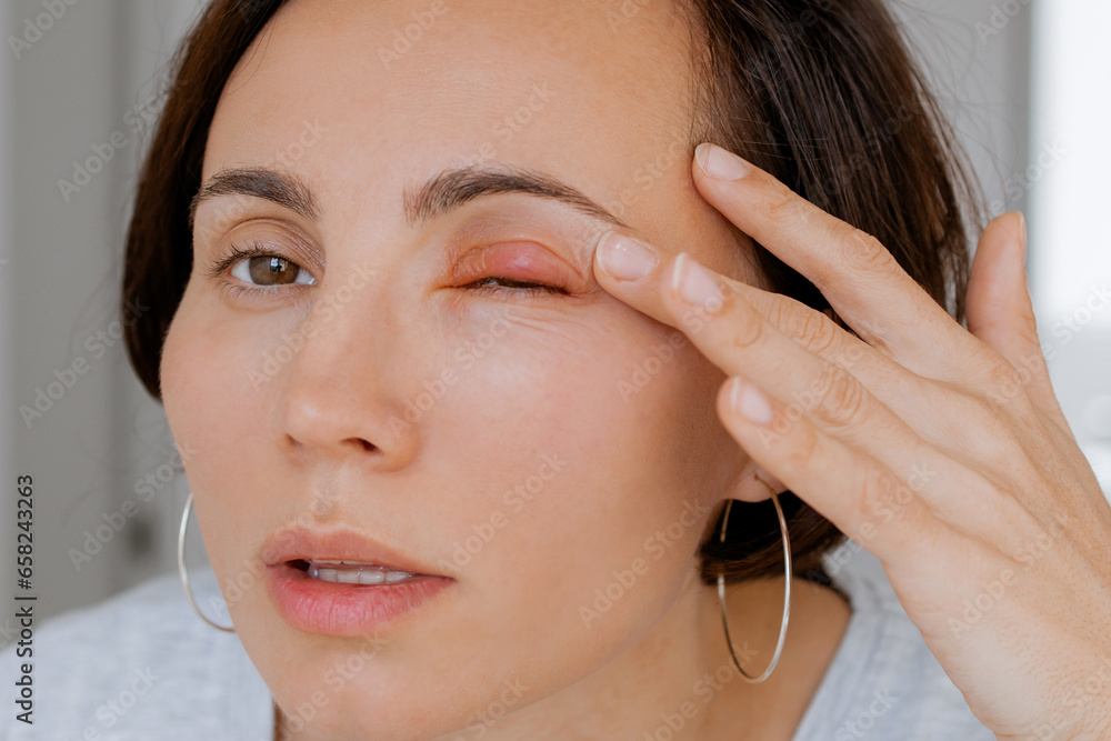 Close up female patient's infected eye. The brown-eyed woman staring at ...