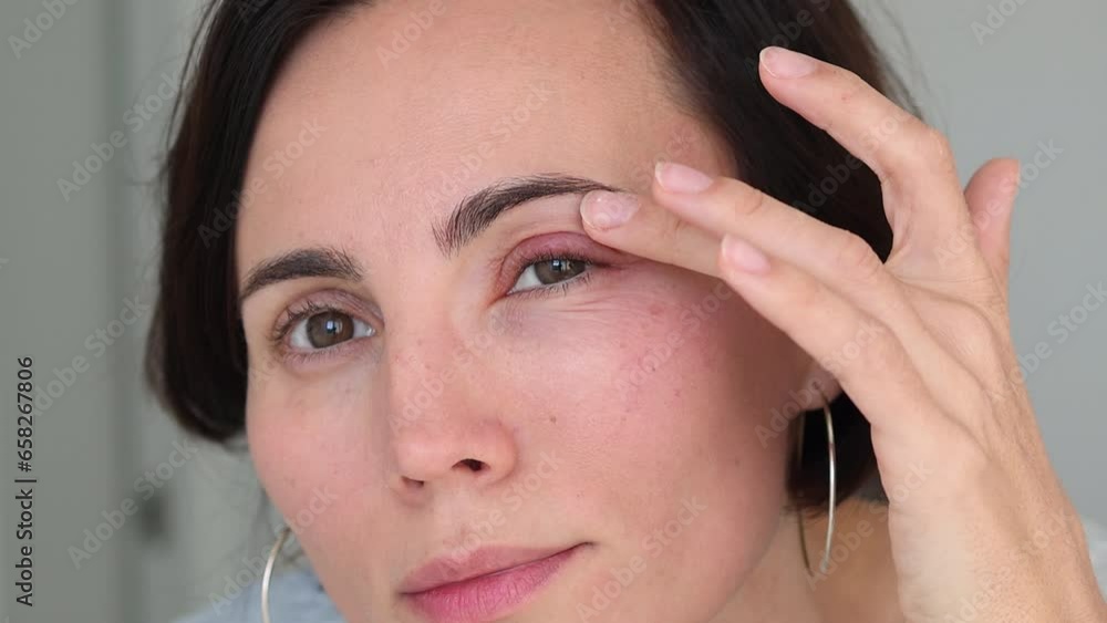 Close up female patient's infected eye. The brown-eyed woman staring at ...