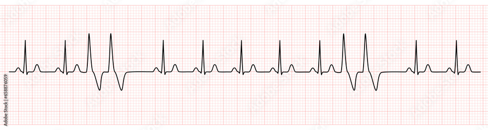 EKG Monitor Showing Sinus Rhythm with Couplets PVC Stock Vector | Adobe ...