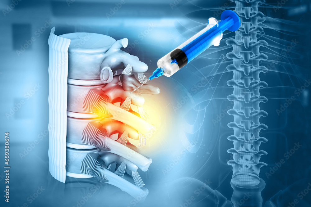 3d illustration of a lumbar spine injection Stock Illustration | Adobe ...
