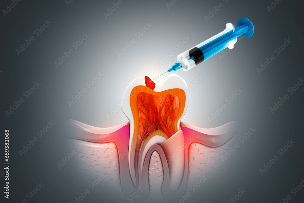 Dental injection. local Dental anesthesia. human jaw with ...