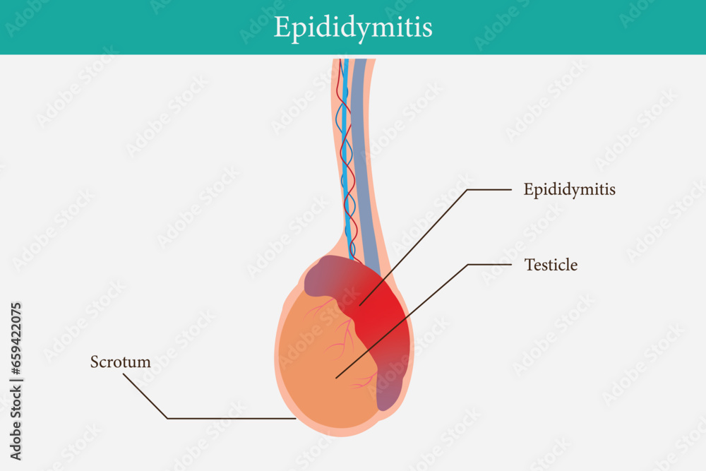 illustration of epididimitis (inflamasi epididimis). Epididymitis is ...