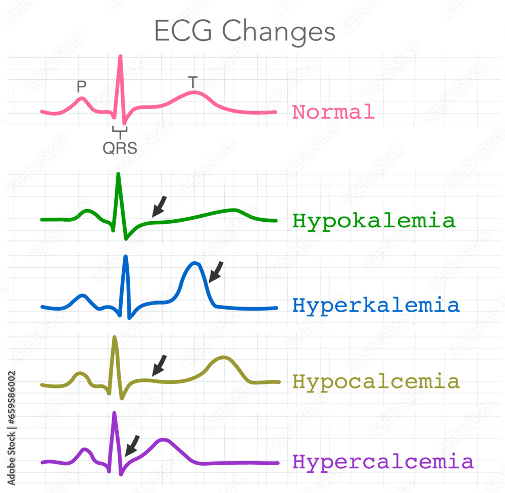 ECG changes. Hypokalemia, Hyperkalemia, Hypercalcemia, Hypocalcemia ...