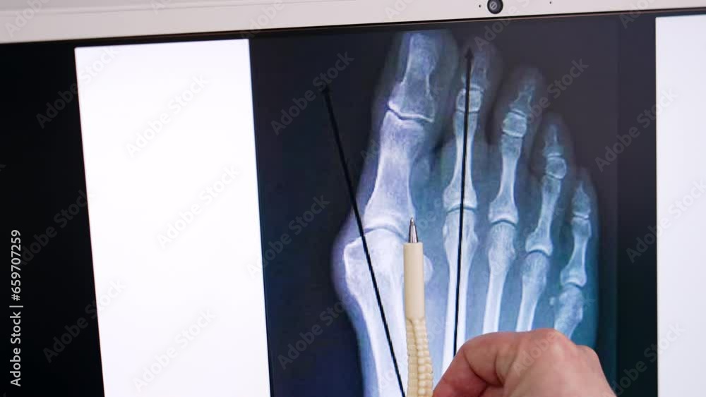 X-ray scan of a foot with valgus deformity. Doctor's hand puts the pen ...