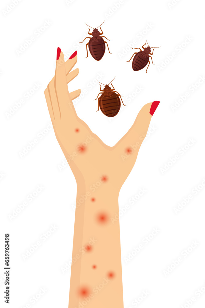 Vector of itchy hand caused by bed bug bite. Bed bug invasion Stock ...