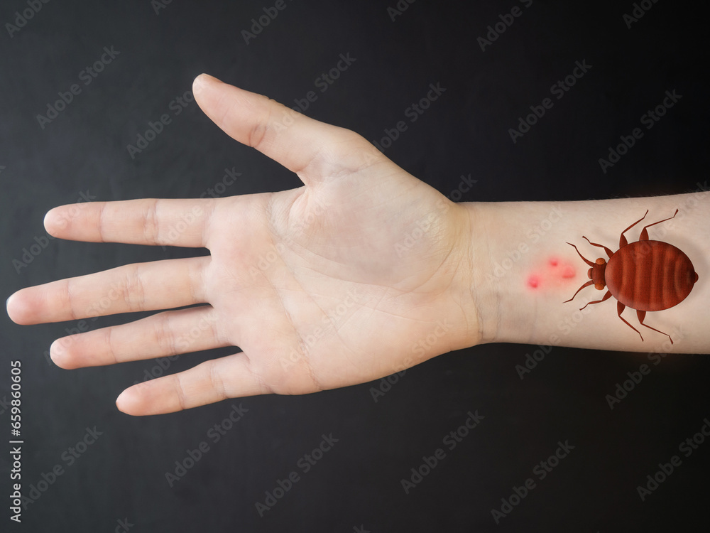 Bedbug bite on the human body. Itchy, red spots on the skin caused by ...