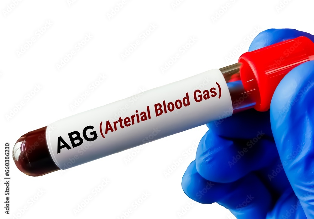 Blood sample tube for ABGs (arterial blood gases) test Stock Photo ...