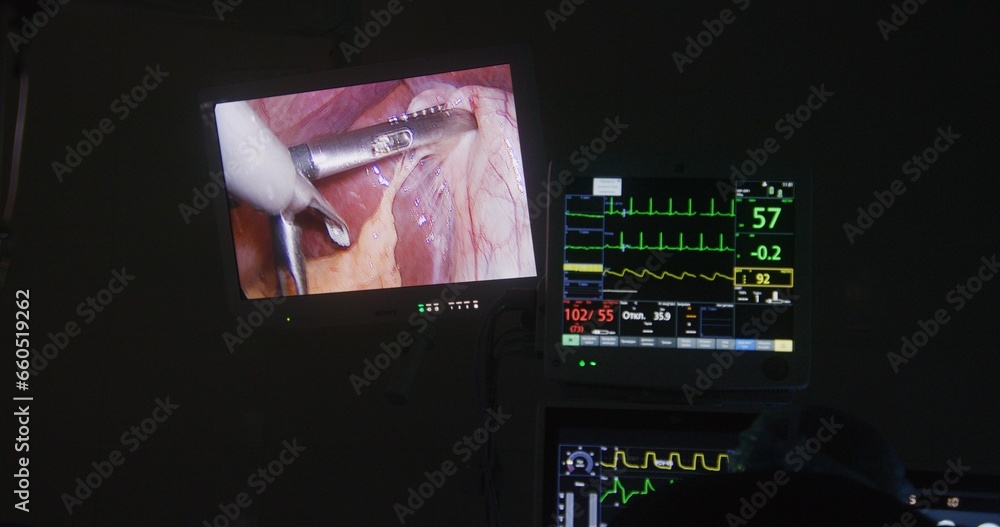 Monitor screen with displayed view from laparoscopic camera during ...