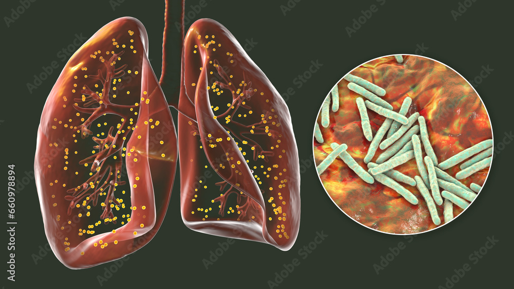 Human lungs affected by miliary tuberculosis, and close-up view of ...