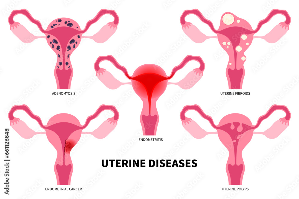Uterine diseases with endometriosis heavy menstruation periods painful ...