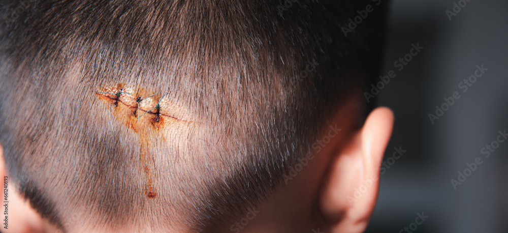 The lacerated sutured wound of kid back head which suture by nylon ...