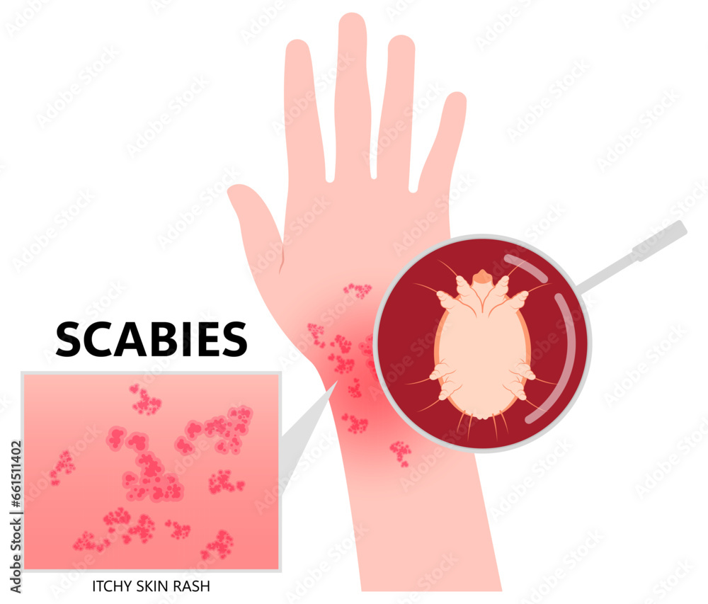 Hand and wrist the dermis skin inflammation with red itching caused by ...