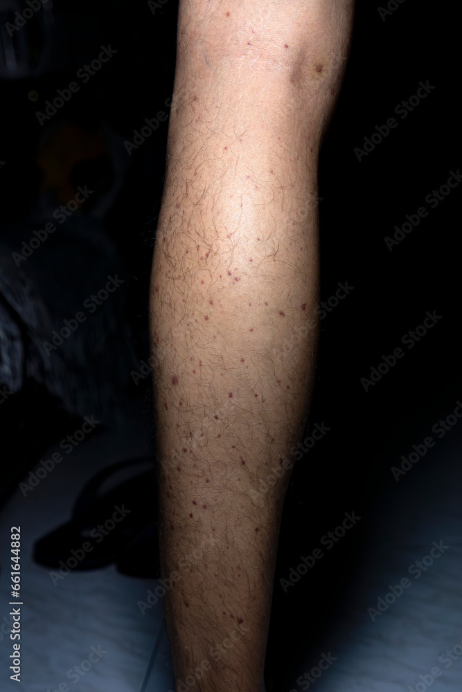Vasculitis. Vasculitis in legs. Small red or purple spots. Post covid ...