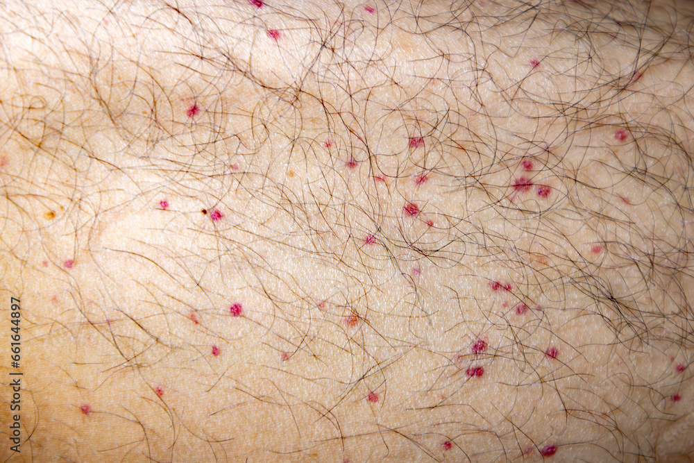 Vasculitis. Vasculitis in legs. Small red or purple spots. Post covid ...