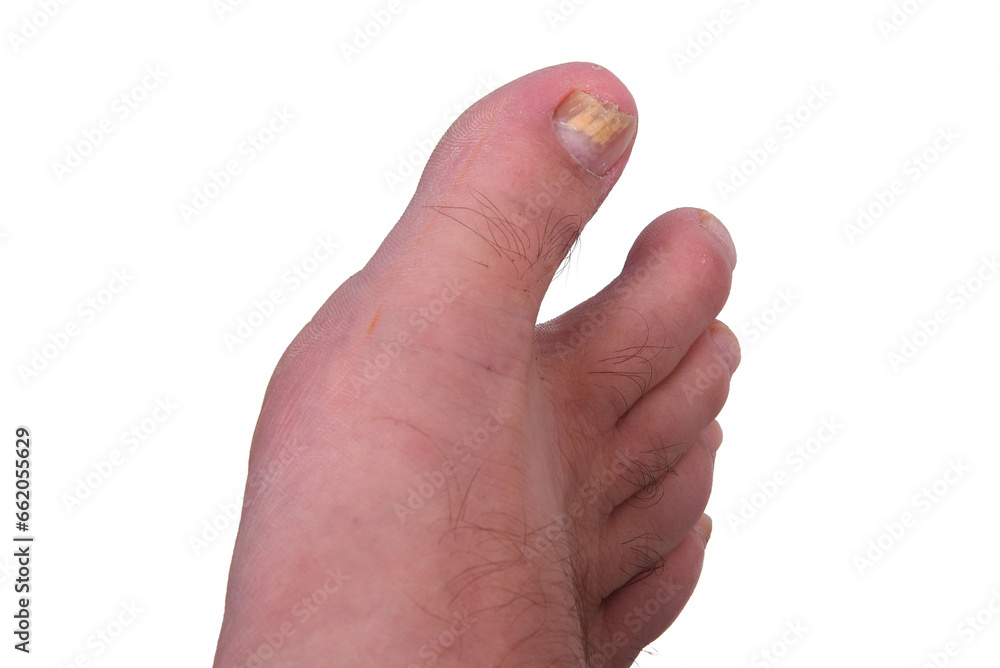 Fotka „Nail fungus infection on big toe. Fungal infection on ...