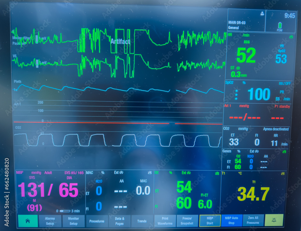 hospital monitor displaying vital signs: heart rate, blood pressure ...