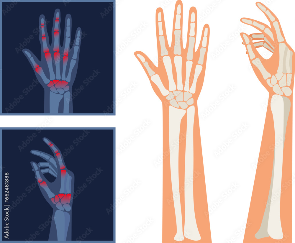 Finger arthritis vector illustration. Rheumatoid Arthritis hands x-ray ...
