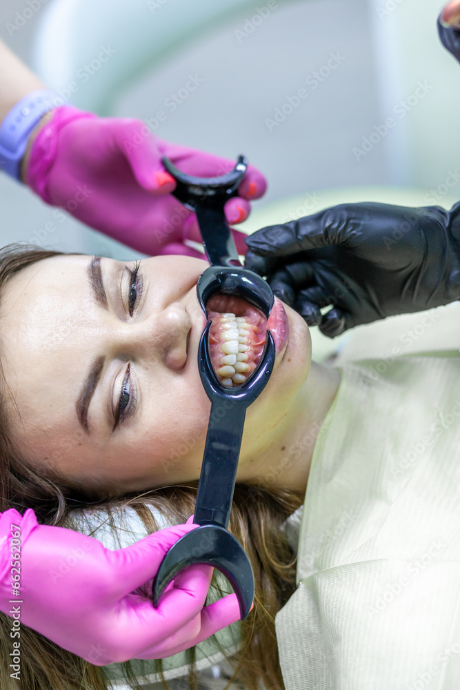 The process of removing braces. Beautiful woman with a mouth expander ...