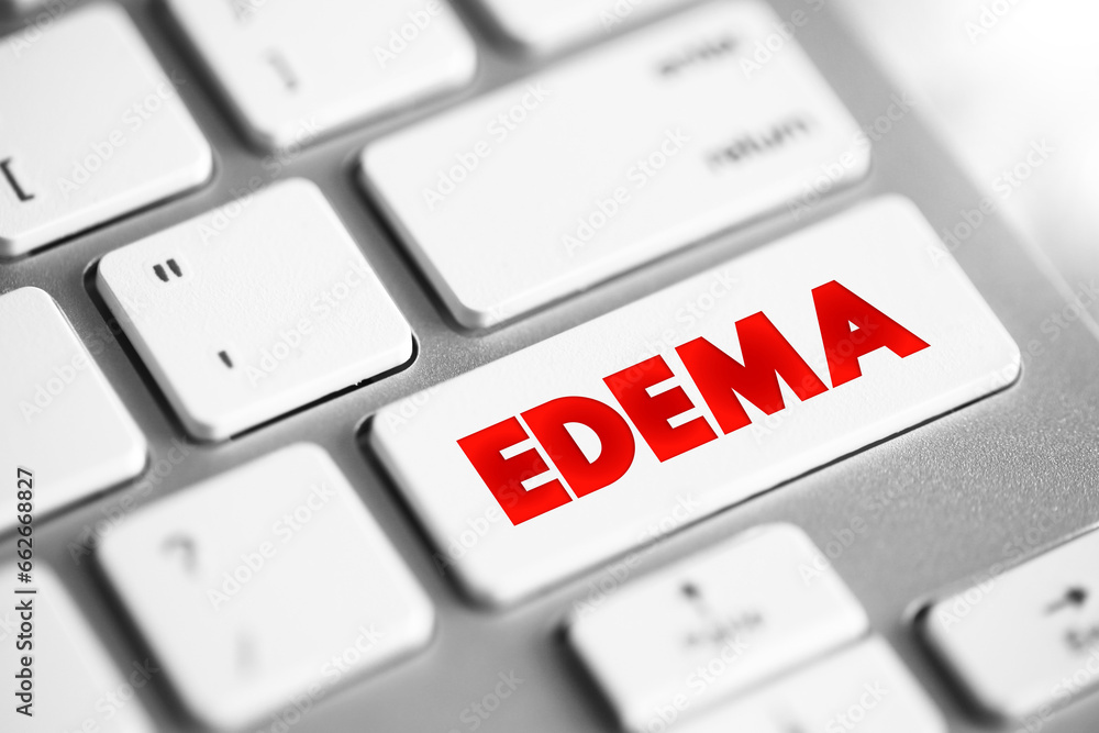 Edema is swelling caused by excess fluid trapped in your body's tissues ...