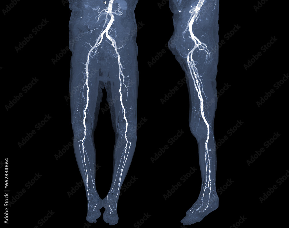 CTA femoral artery run off image of femoral artery for diagnosis Acute ...
