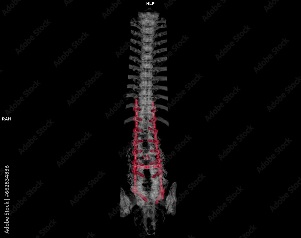 CT scan of thoracic and lumbar spine 3d rendering showing pedicle screw ...