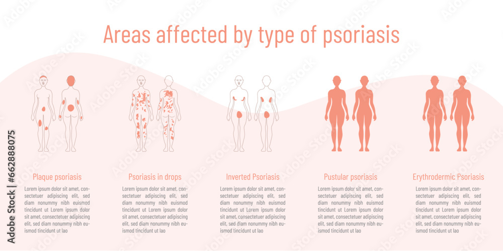 Infographic on affected areas according to the type of Psoriasis ...