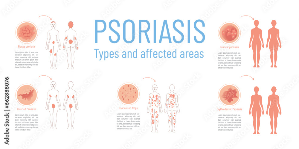 Infographic with graphic representation of the different types of ...