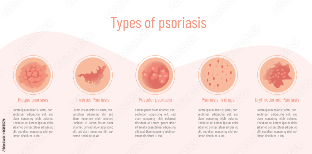 Infographic on the type of psoriasis and what it looks like. Stock ...