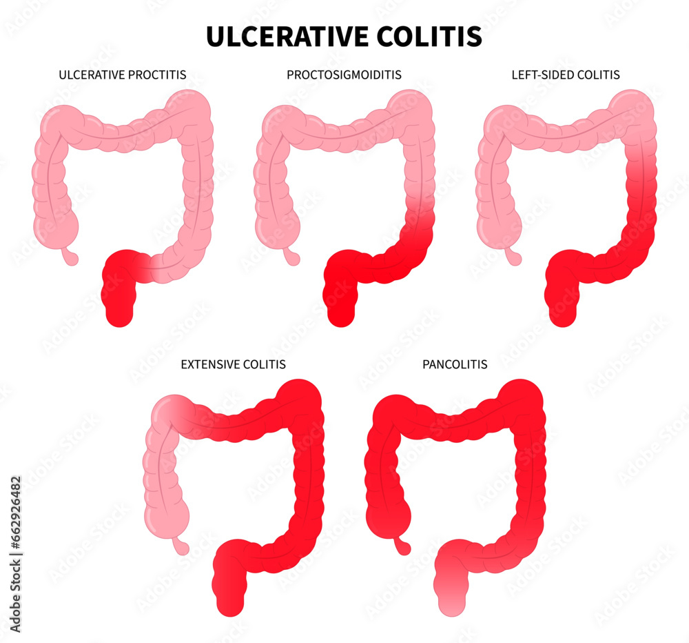Types of Diarrhea or Ulcerative colitis and Crohn's disease with ...