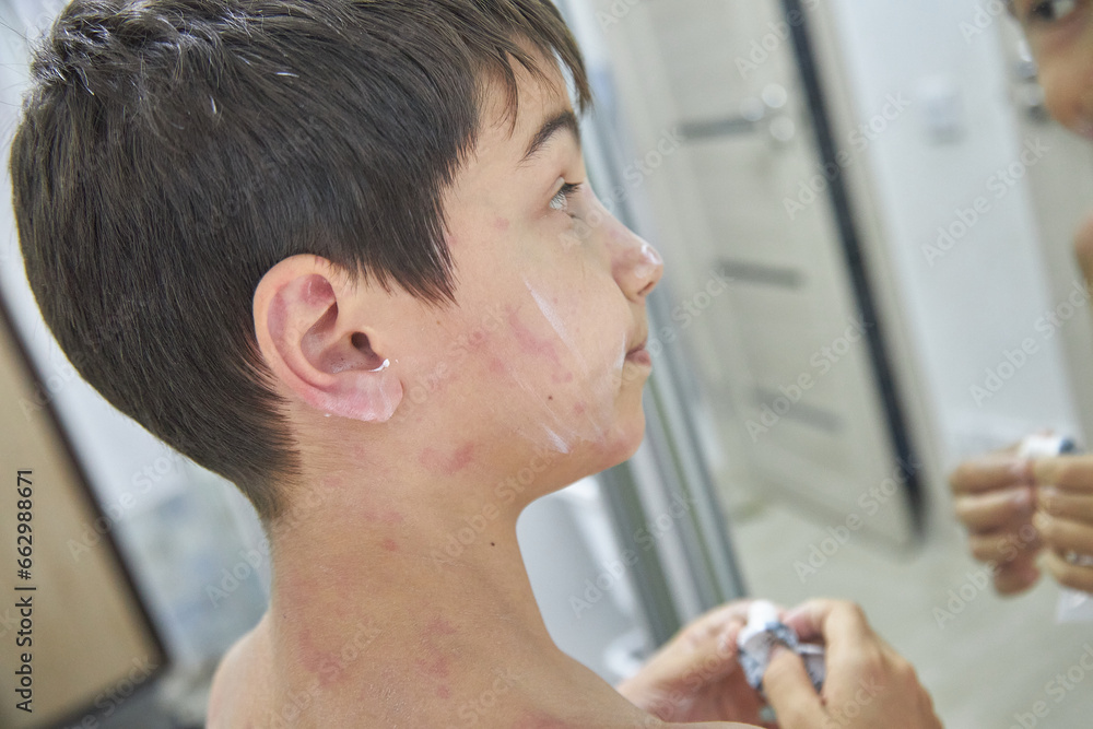 Skin itching, dermatitis, food allergy on the face. A boy with red ...