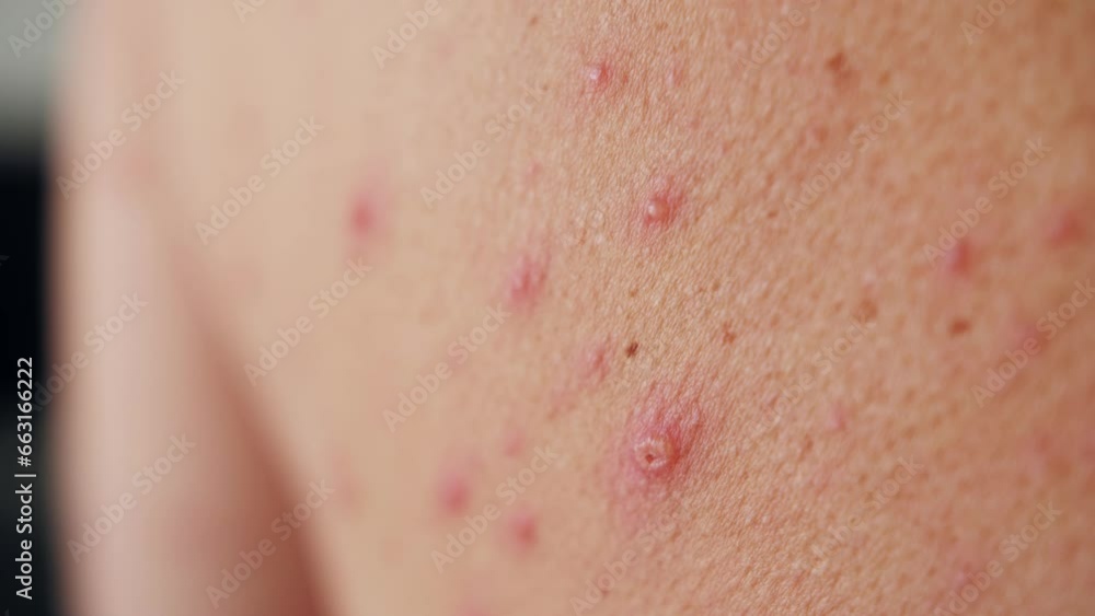Close-up of chicken pox on the back of an adult person. The classic ...