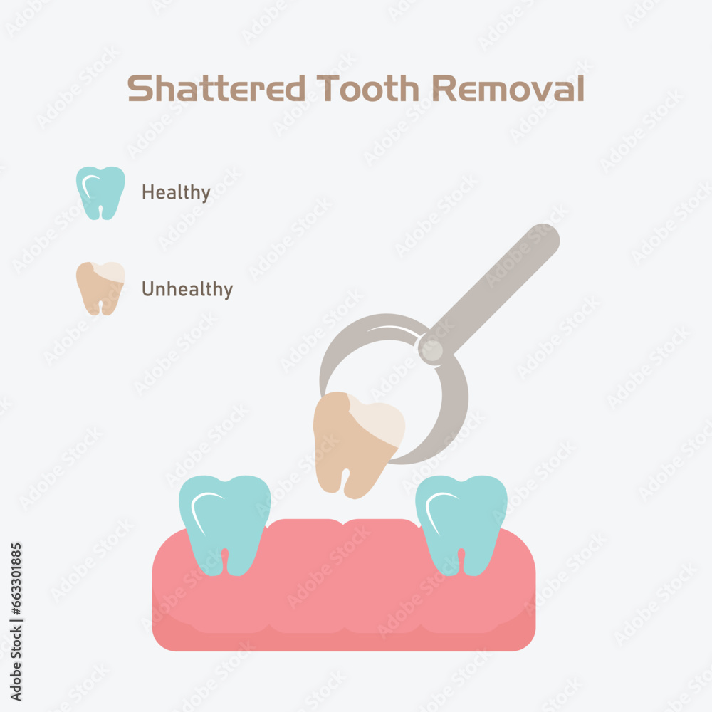 Unhealthy tooth removal process concept vector illustration. Dental ...