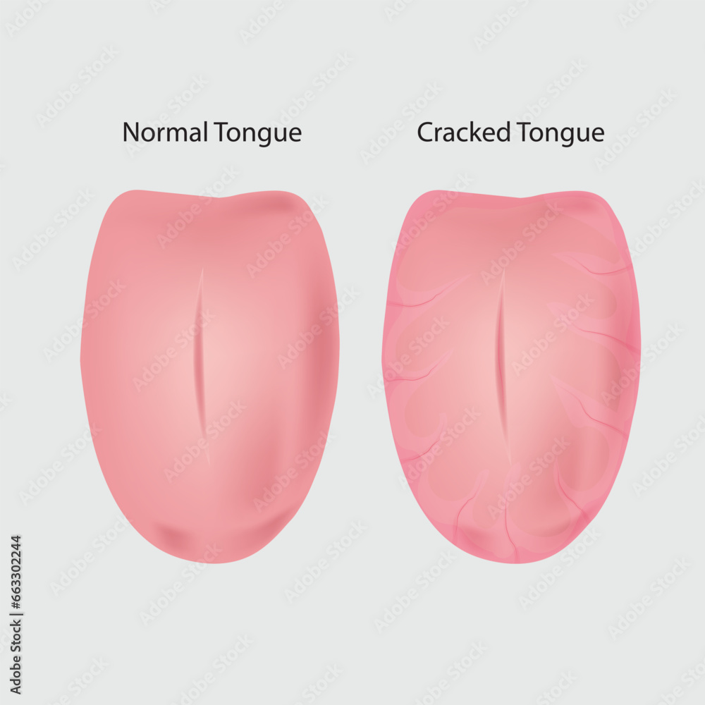 Disease of the tongue, cracks. medical illustration, health sign vector ...