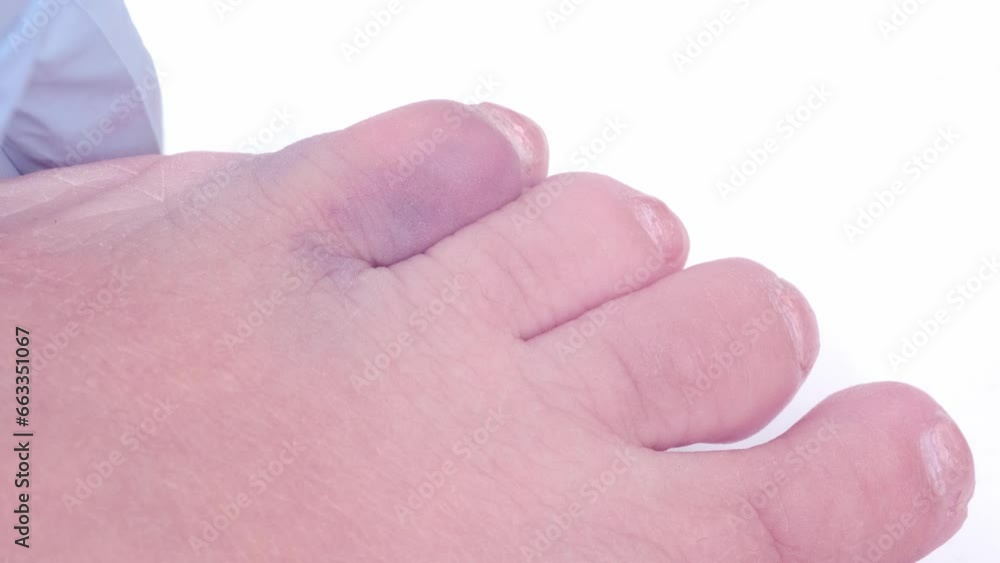 traumatologist examines injured little toe, concept of fracture, bruise ...