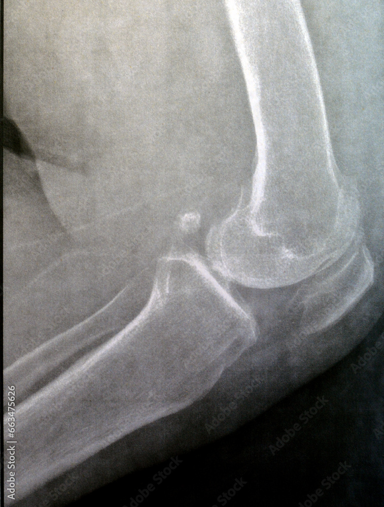 Foto de Plain X ray of the left knee shows apparent joint ...