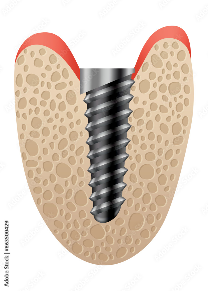 Dental implant structure. Medical educative infographic poster. Teeth ...