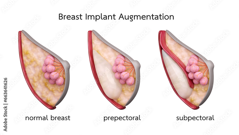 Breast implant augmentation or breast surgery, insert silicone gel with prepectoral and ...