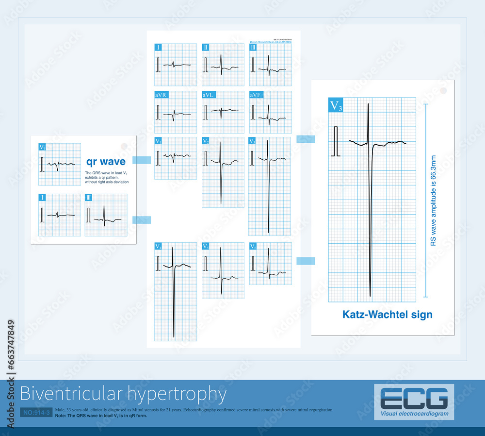 When the QRS wave in the V2-V4 chest lead is biphasic and has an ...