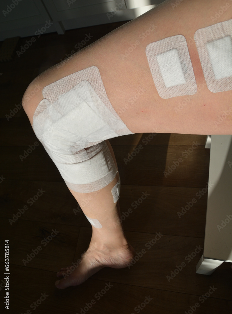 A close-up of a human leg after varicose vein surgery using the newest ...