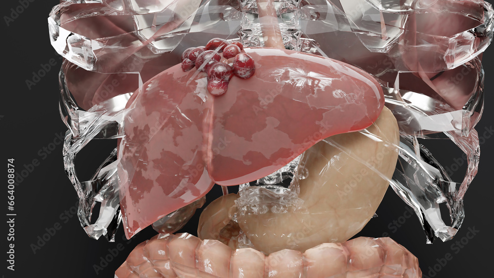 Digestive Organ Liver Cancer, Hepatitis cirrhosis malignant tumor ...