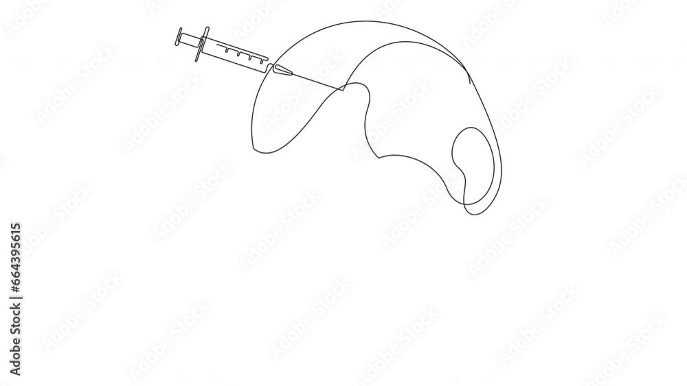 Self drawing animation of platelet rich plasma injection procedure for ...